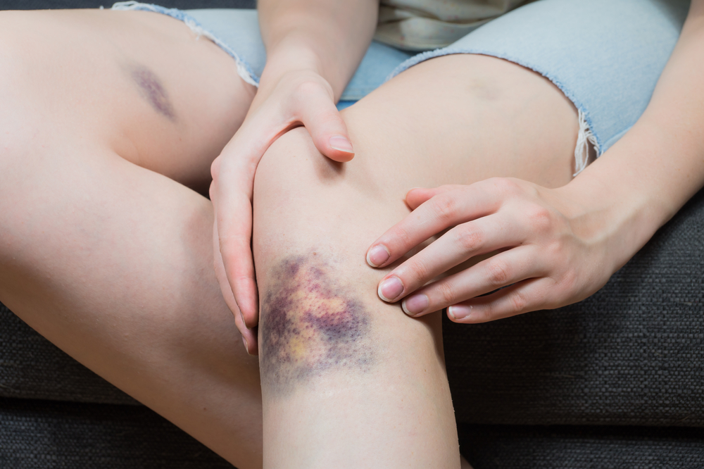 Compensation for Bruising after a Car Accident - It's possible?